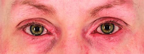 Moderate Conjunctivitis And Blepharitis At Week 22 Of Dupilumab