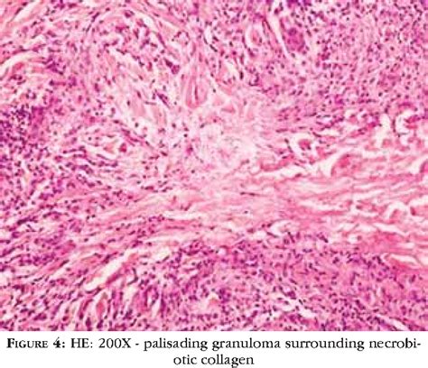 Granuloma Annulare Histopathology