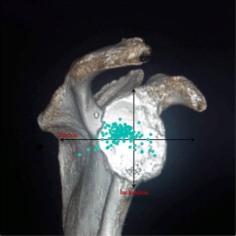 The Distribution Of Glenoid Inclination And Version Angle For The