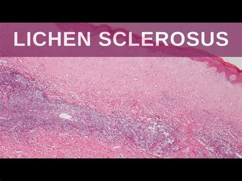 What Is Lichen Sclerosus Symptoms Causes Diagnosis And More Chiid