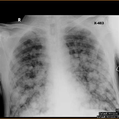 Chest X Ray Showing Multiple Nodular Lesions Involving Both Lungs