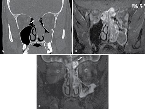 Radiologic Evaluation Of Skull Base Masses Clinical Tree