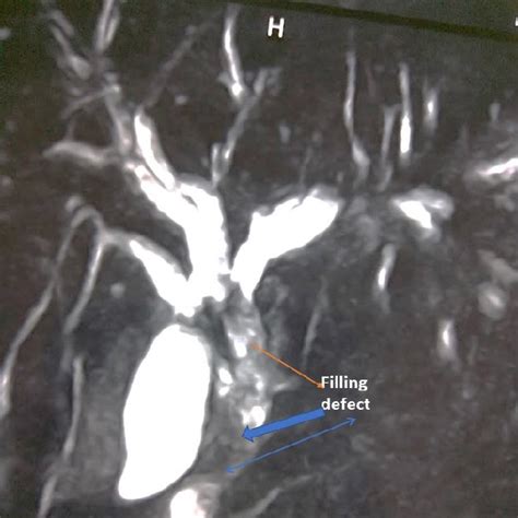 Mr Cholangiogram Showing Irregular Filling Defect Download Scientific Diagram