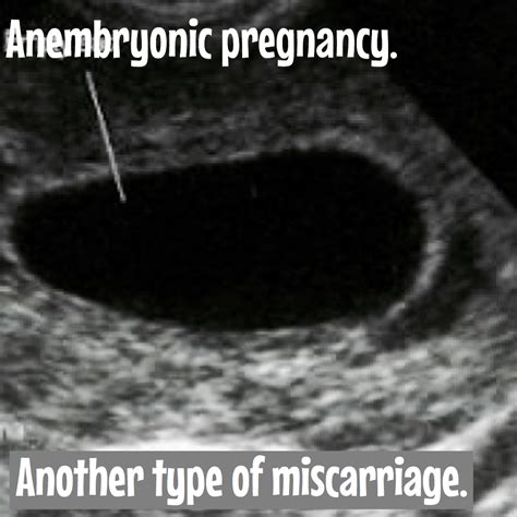 All You Need To Know About Miscarriages Ultrasoundfeminsider