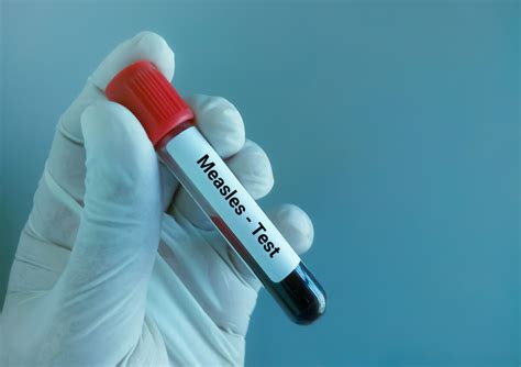 Macomb County Measles Case Linked To Canadian Outbreak Planet Detroit