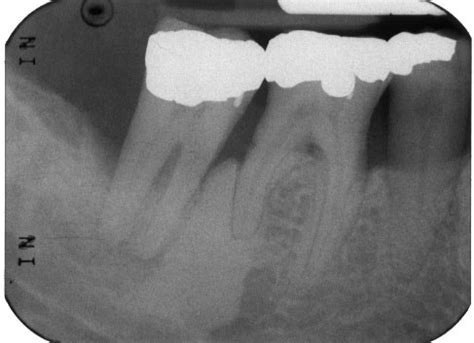 Ask Radiology Is Osteosclerosis A Diagnosis Or Simply Describing Something Seen On A