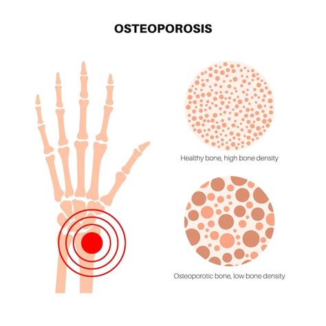 Bone Density Vectors And Illustrations For Free Download Freepik