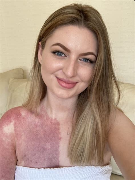 Rowanne Simpson Vascular Birthmarks Foundation