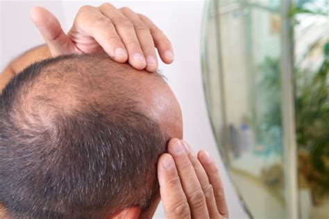 Effective Dht Hair Loss Treatment In Sydney Hair Doctors