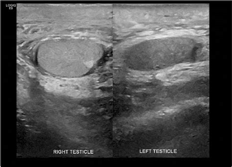 Navigating Isolated Scrotal Lymphedema