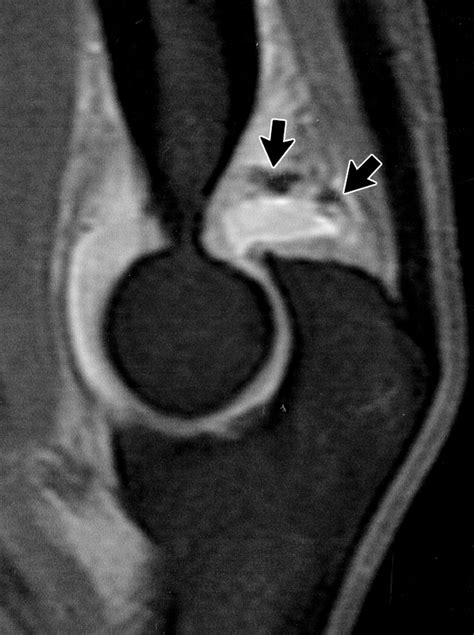Synovial Cyst Elbow Mri At Armando Mendoza Blog