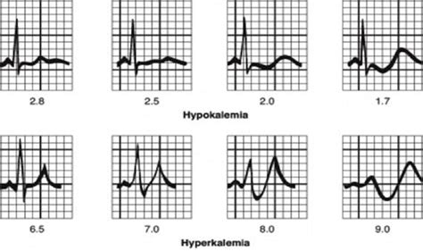 Hyperkalaemia Clinical Case • Litfl • Clinical Case