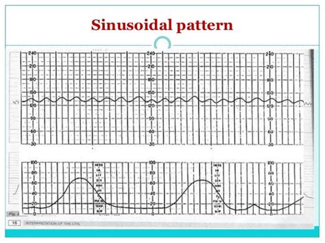 Intrapartum Fetal Monitoring For Undergraduate