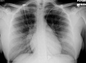 Initial Chest Radiograph Showing Diffuse Interstitial Infiltrates And Download Scientific