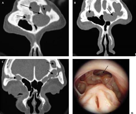 Extended Approaches To The Frontal Sinus The Modified Endoscopic