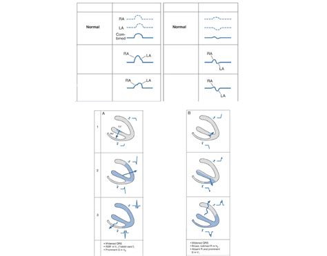 Qrs Abnormalities Quiz