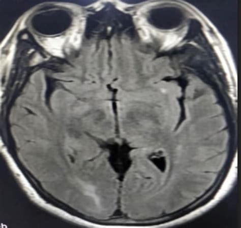 Mri Brain Showing T2flair Hyperintensities In Occipital Lobes