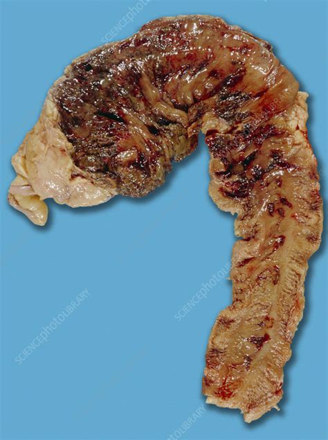 Ischaemic Colitis Stock Image M130 0932 Science Photo Library