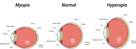 Astigmatism Severity Scale How To Determine Your Level