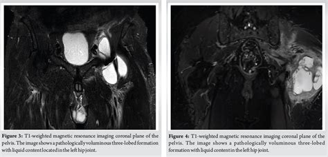 A Rare Case Of Staphylococcus Caprae Periprosthetic Hip Infection With Unusual Clinical
