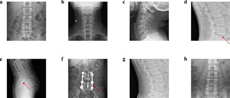 Gan Generated Synthetic Spine Radiographs Specified To Produce Normal