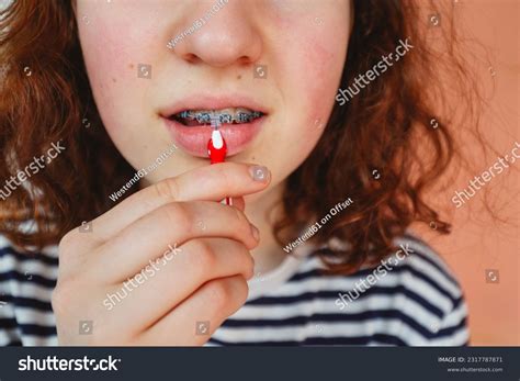 Braces Color Selector For Girls