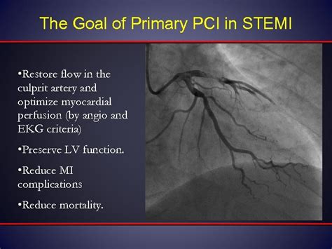 Stemi Interventional Techniques And Antithrombotic Therapy In