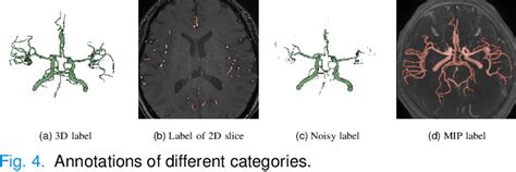 Figure 1 From 3d Vascular Segmentation Supervised By 2d Annotation Of