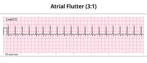 Ecg Atrial Flutter 8 Second Electrocardiography Paper Stock