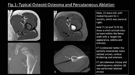 Figure 1 From Osteoma Osteoid The Great Mimicker Semantic Scholar