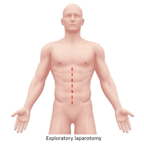 Exploratory Laparotomy Download Scientific Diagram