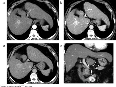 Figure 1 From Cholangiolocellular Carcinoma Of The Liver Exhibiting High F 18 Fdg Uptake