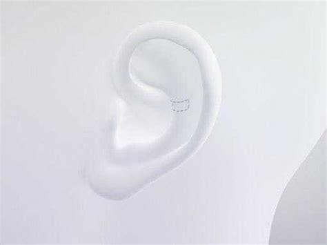Earfold Implants Prominent Ears Treatment With A Short Recovery