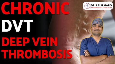 Chronic Dvt Symptoms Causes Diagnosis Prevention And Treatment By