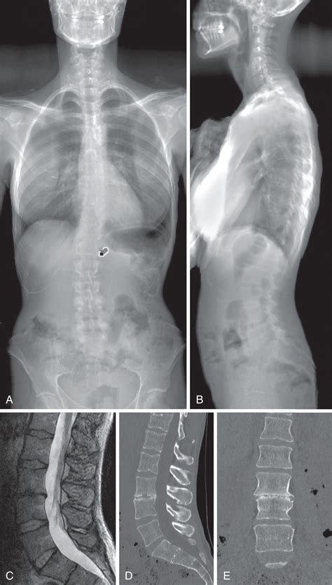 Robotic Assisted Percutaneous Fixation Clinical Tree