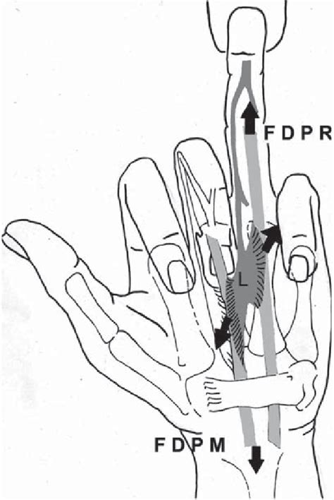 Lumbrical Injury