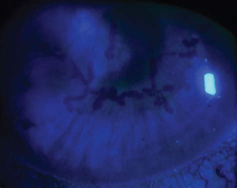 Keratitis Home Treatment At Donald Stoltenberg Blog