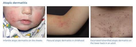 Dermatology 101 Conditions 01 20 Gp Exams