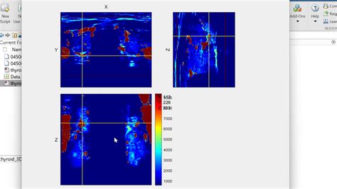 Integrated Synchronization And Triplanar Reconstruction Of 4d B Mode And Color Doppler Thyroid