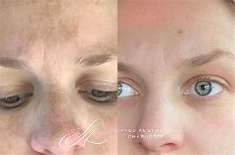 Photofacial Treatment Charlotte Nc Davidson Lifted Aesthetic