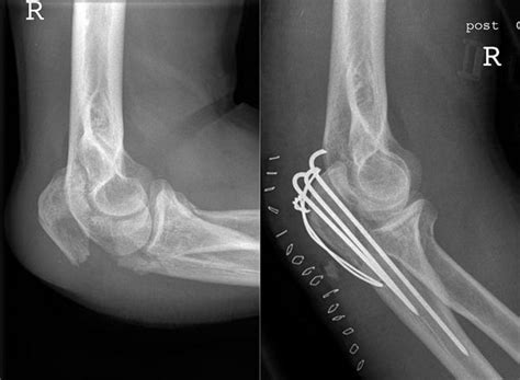 Olecranon Fracture Physiopedia