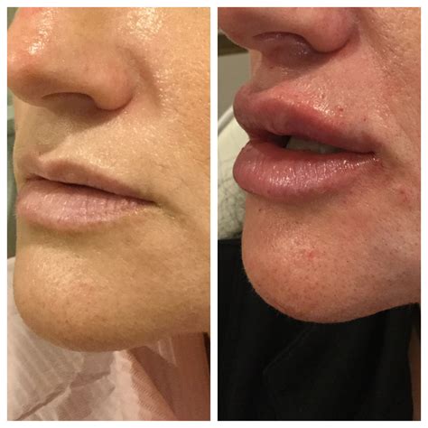 Chin Botox Dramatic Before And After Transformations Cost Results And More Chaztin