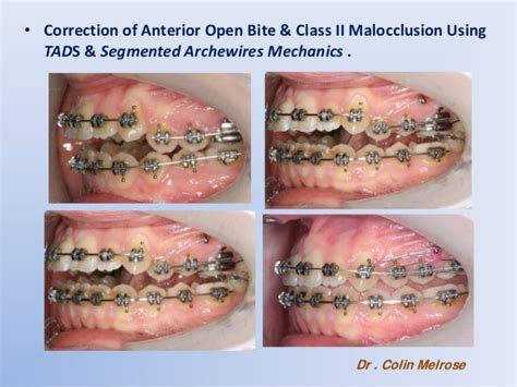 Anterior Open Bite Treatment In The Permanent Dentition Part 2