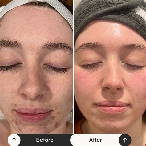 Led Light Therapy Treatments Enhance Your Skin Care Routine Today