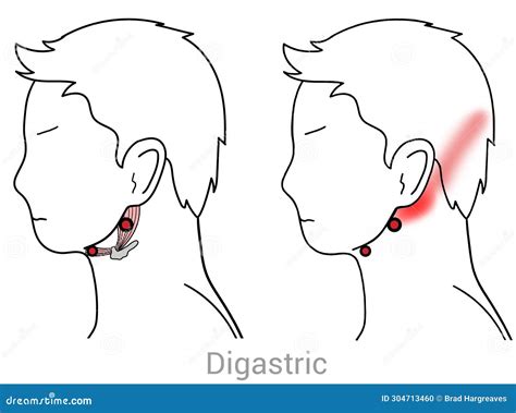 Myofascial Trigger Points Vector Illustration