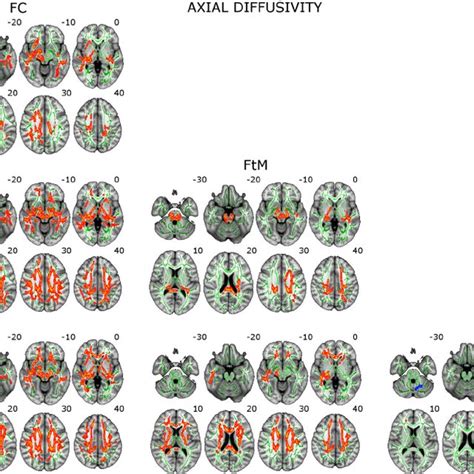 Effects Of Gender Identity And Sex On Regional Ad See Schema In Figure Effects Of Gender Identity And Sex On Regional Ad See Schema In Figure