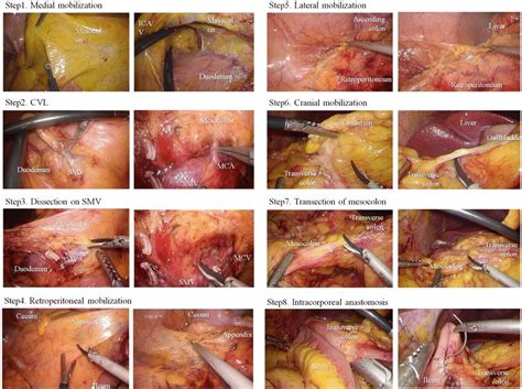Deep Learning Based Surgical Step Recognition For Laparoscopic Right Sided Colectomy Bohrium