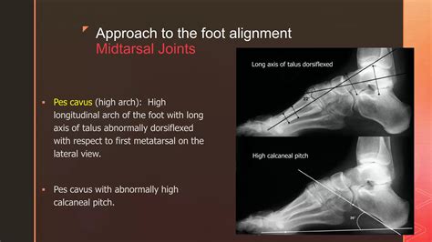 Radiographic Assessment Of Pediatric Foot Alignment Pptx