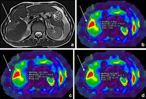 A 64 Old Male Patient With Colorectal Liver Metastasis In The Right