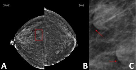 Craniocaudal View Of The Bilateral Breasts A Right Breast B Left Download Scientific